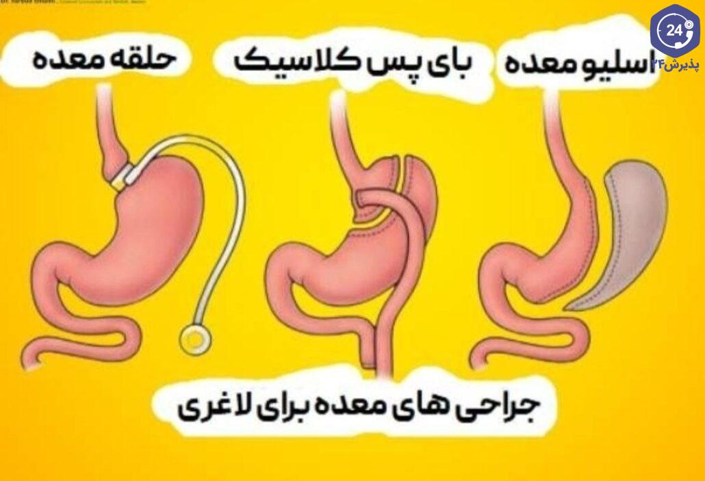 بررسی تفاوت های عمل اسلیو معده یا بای پس معده پذیرش۲۴
